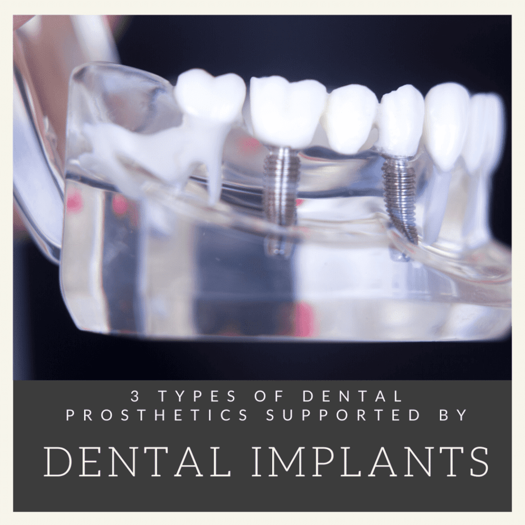 3 Dental Prosthetics Supported by Dental Implants - Empire Dental