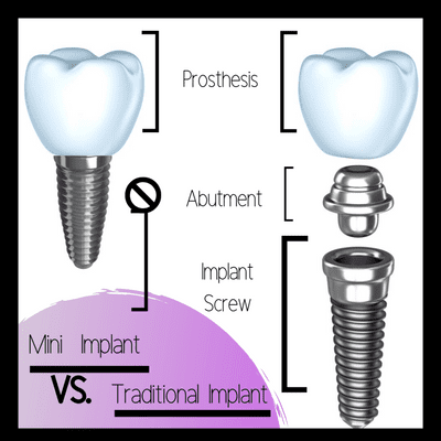 The Top 3 Things You Need to Know About Mini Dental Implants - Advanced ...