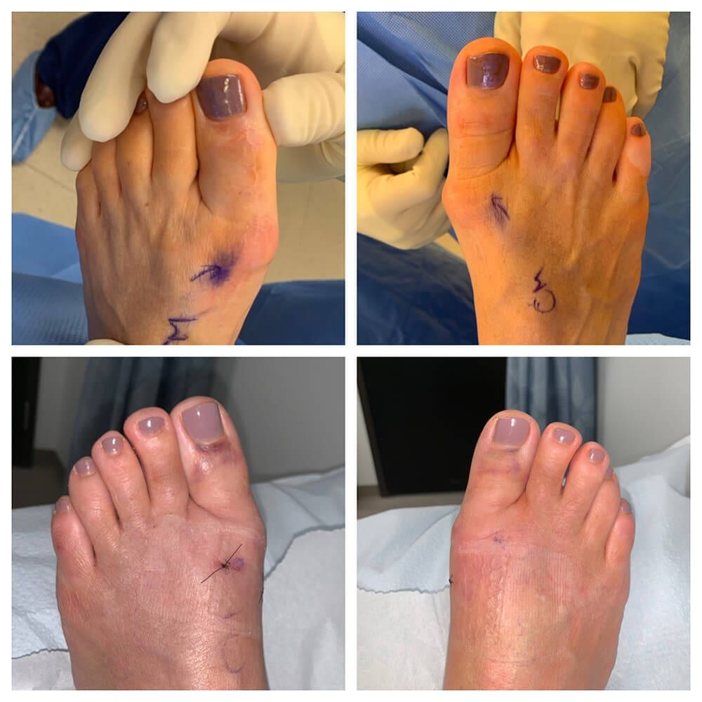 Hallux Rigidus Arthritis Of The Big Toe Christopher Miller