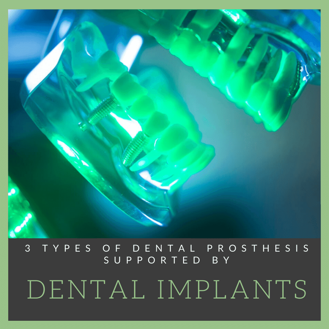 The Three Type of Prostheses Supported by Dental Implants