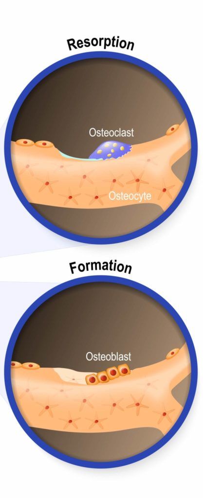 Learn How Bone Grafting May Help Restore Your Beautiful Smile