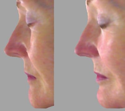 Facial Changes Resulting From Palatial Expansion Following Homeoblock