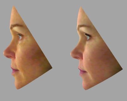 Facial Changes Resulting From Palatial Expansion Following Homeoblock