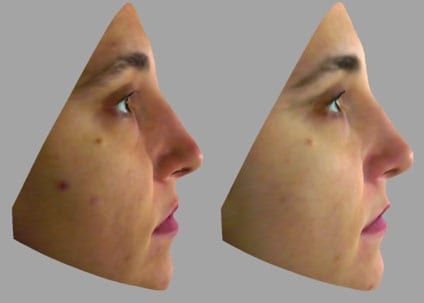 Facial Changes Resulting From Palatial Expansion Following Homeoblock